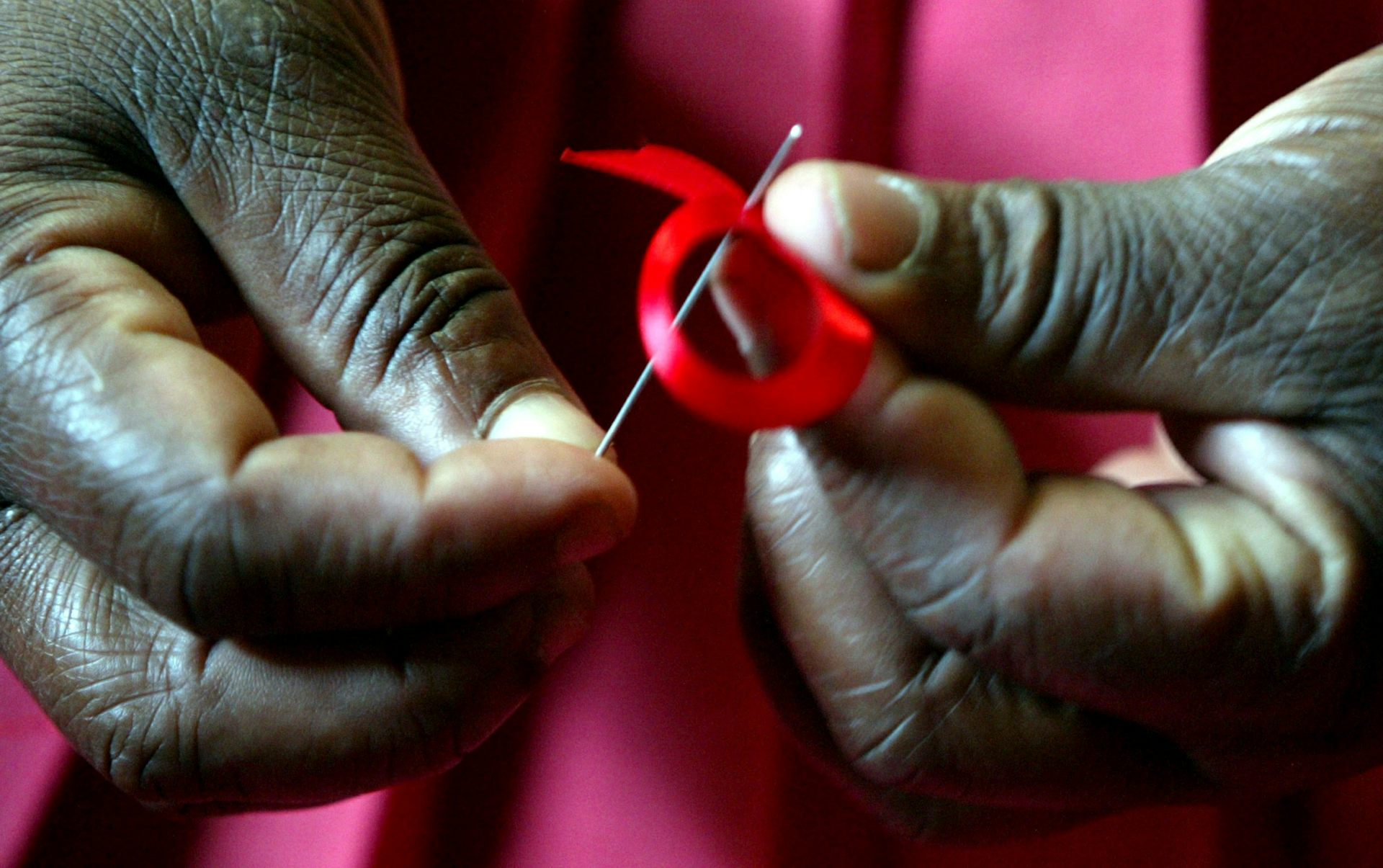 Scalp Sores Hiv