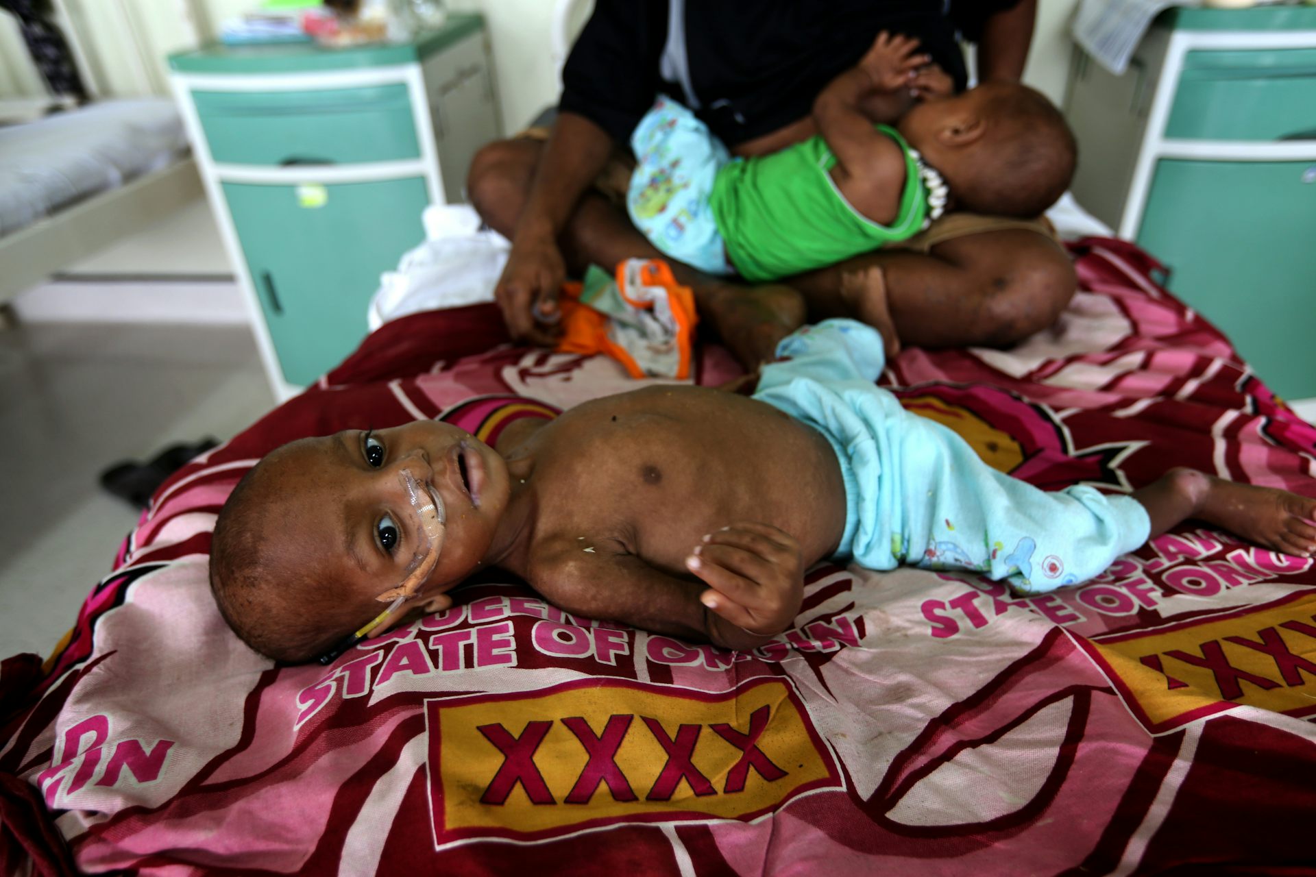 Stunted growth ‘and’ obesity: the double burden of poor nutrition on ...