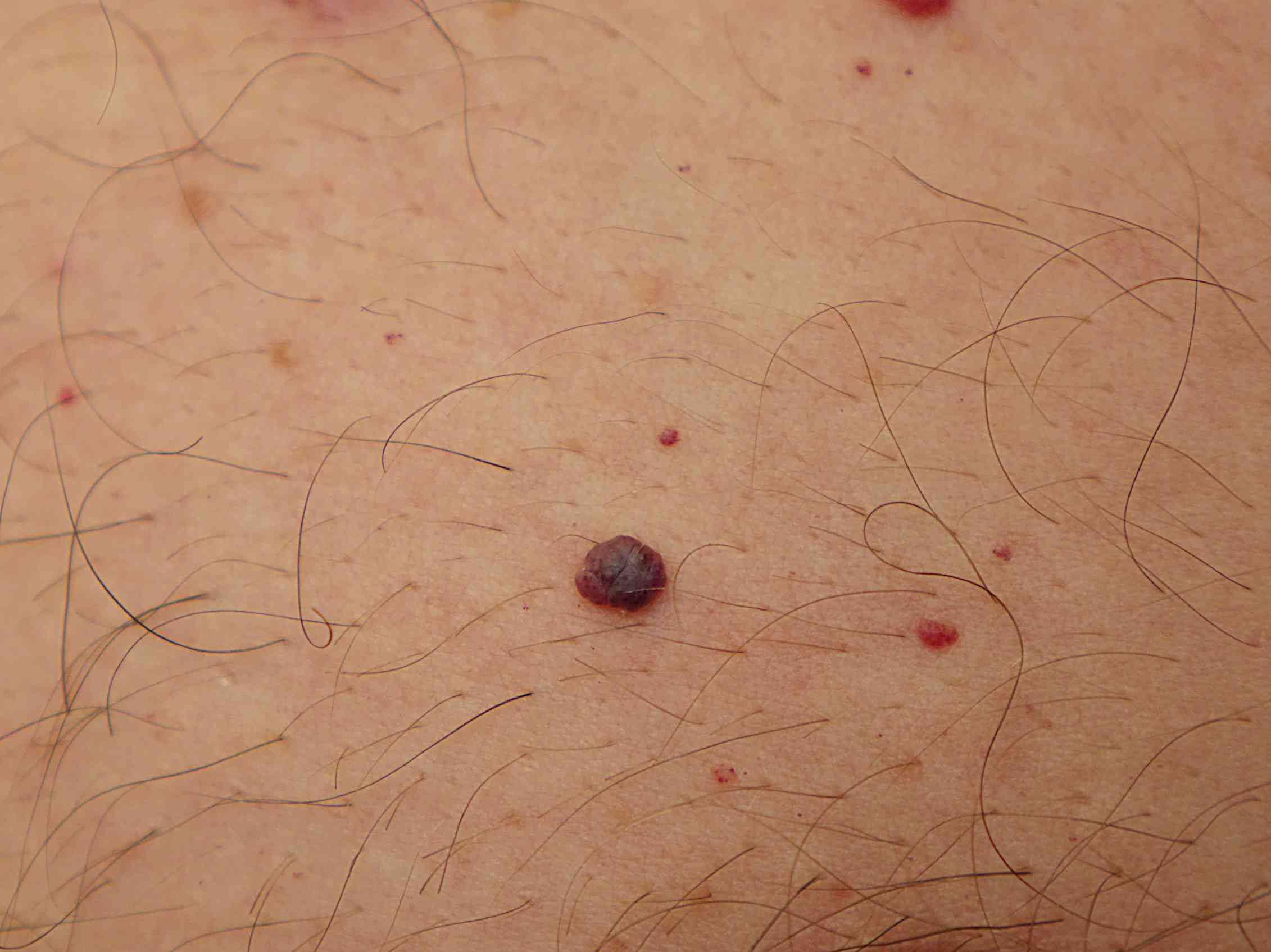 Common lumps and bumps on and under the skin: what are they? Common lumps and bumps on and under the skin: what are they?