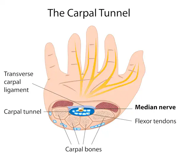 Explainer What Is Carpal Tunnel Syndrome And What Happens If I Get It Explainer What Is Carpal Tunnel Syndrome And What Happens If I Get It