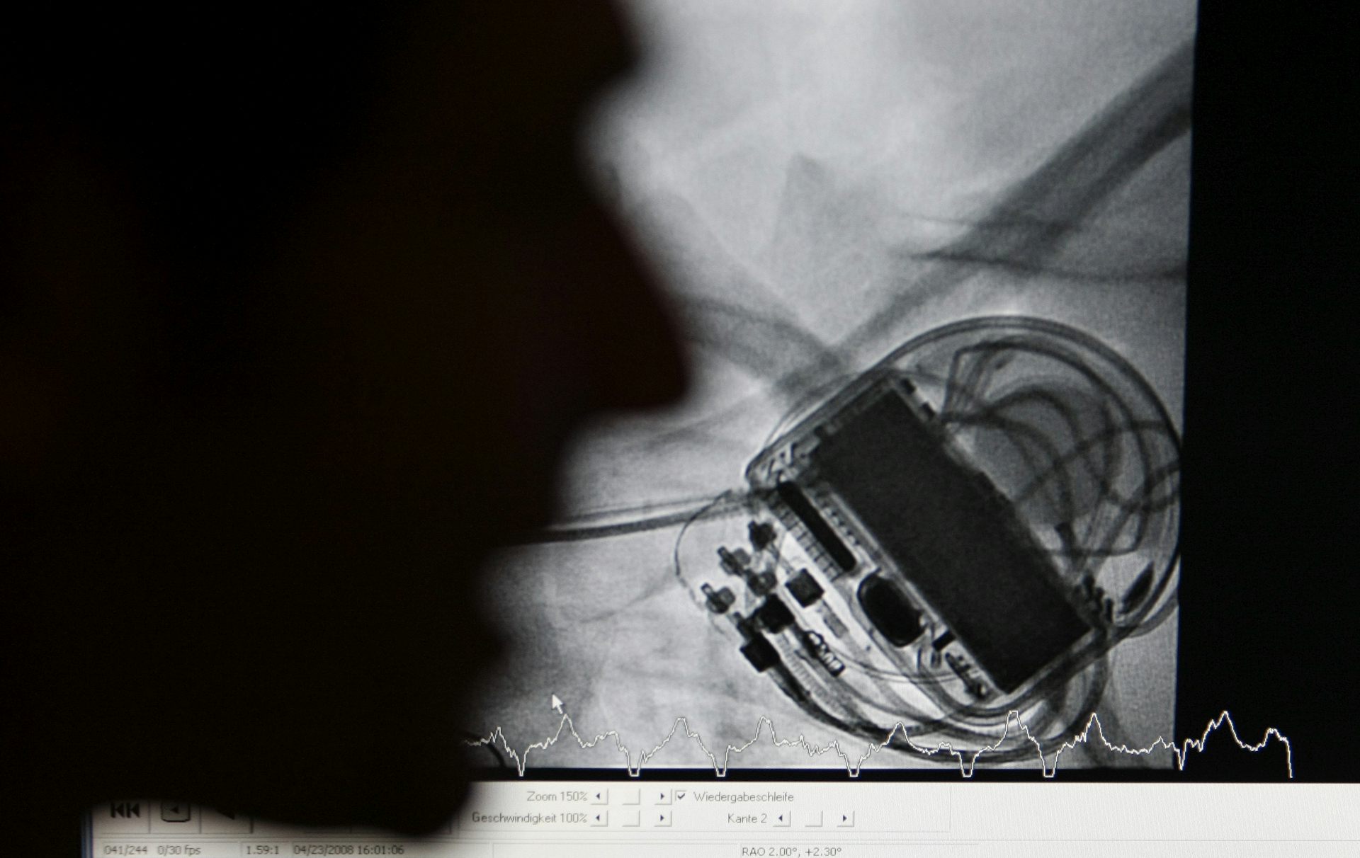 Three reasons why pacemakers are vulnerable to hacking