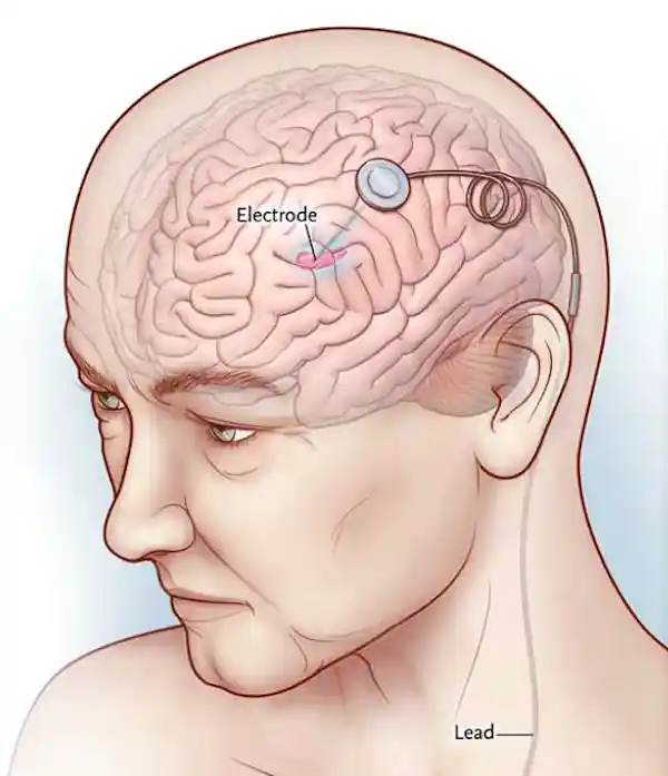 Deep Brain Stimulation A Fix When The Drugs Don t Work Deep Brain Stimulation A Fix When The Drugs Don t Work