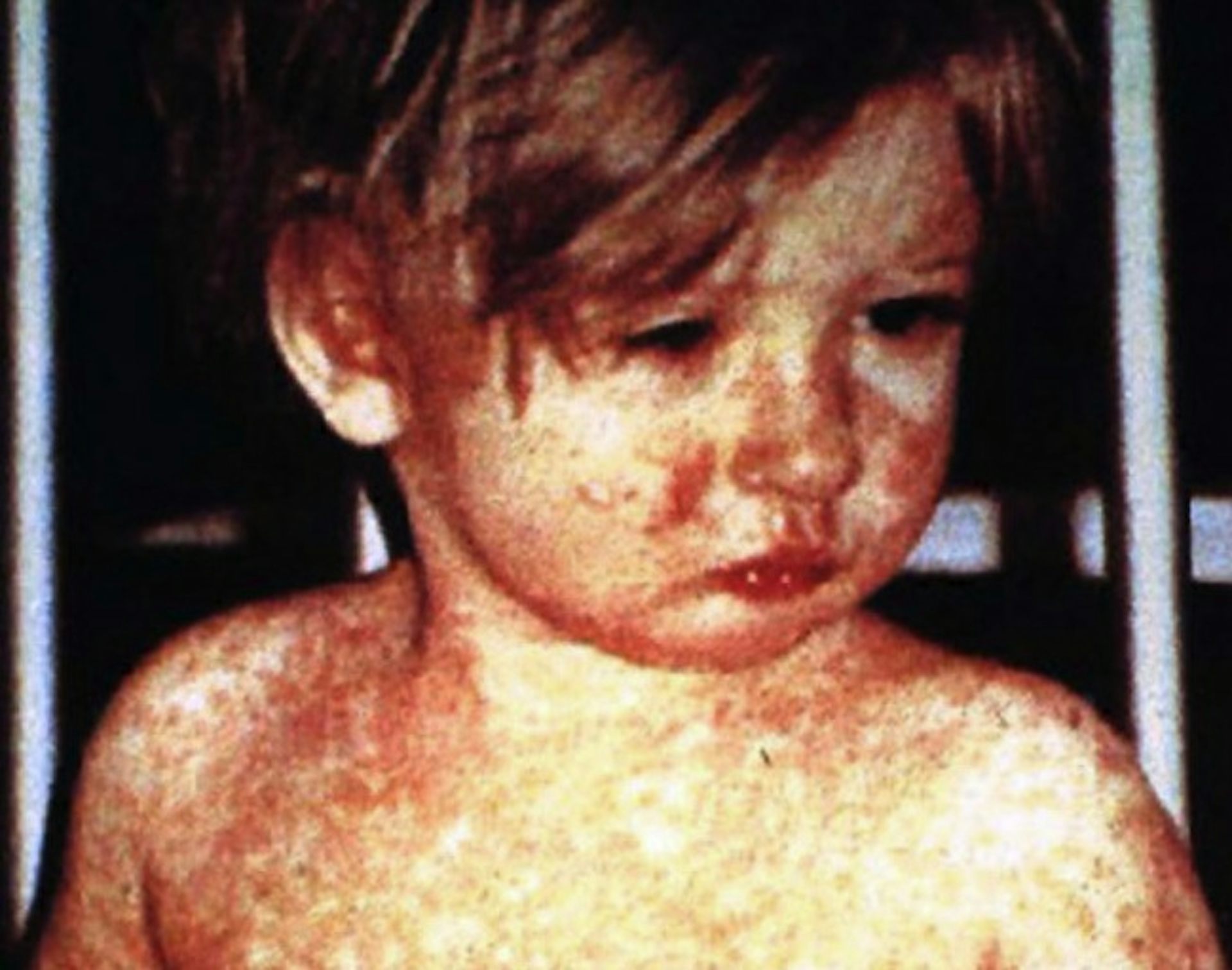 Measles outbreaks show the illness is down, but not yet out