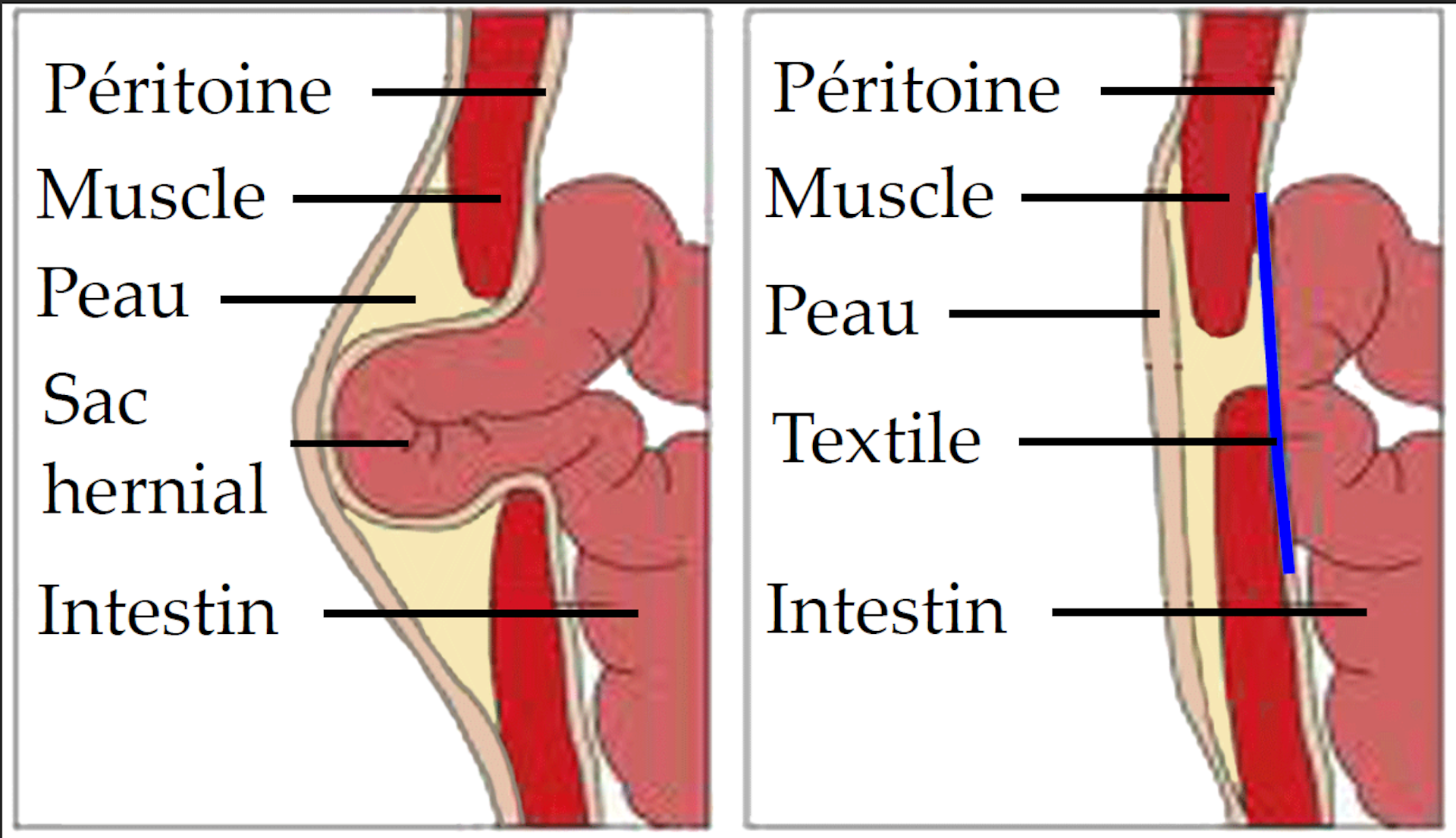 De nouvelles technologies pour éviter les hernies postopératoires