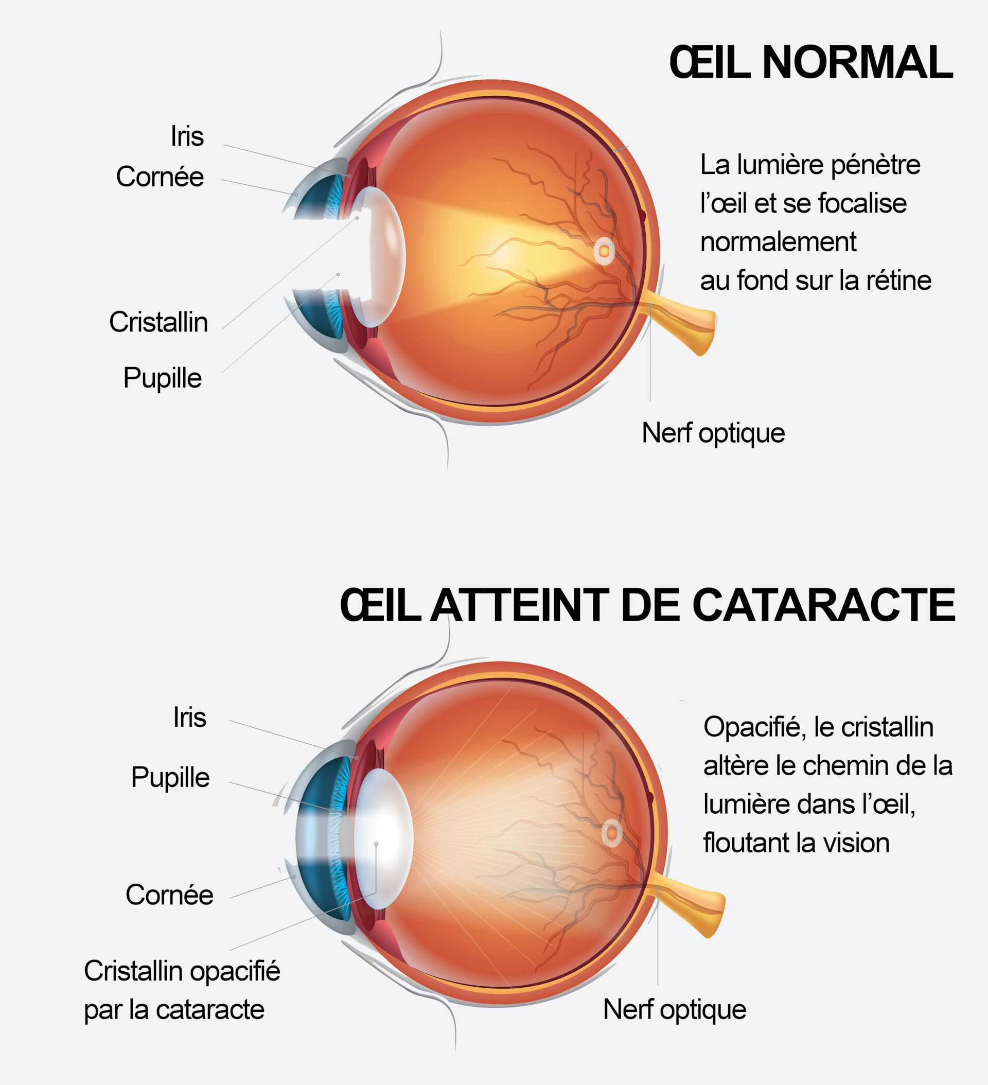 Cataracte : bientôt un traitement qui se passe de chirurgie