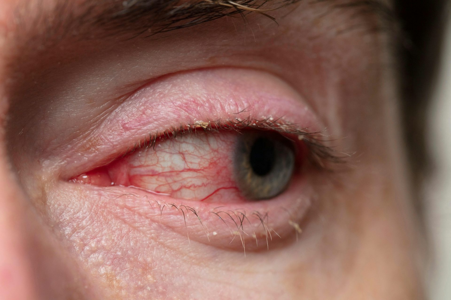 The risks of swimming with your eyes open underwater