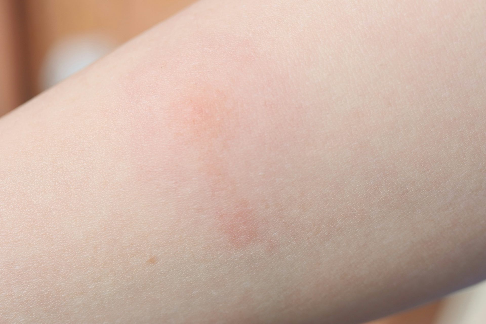 What causes the itch in mozzie bites? And why do some people get such a ...