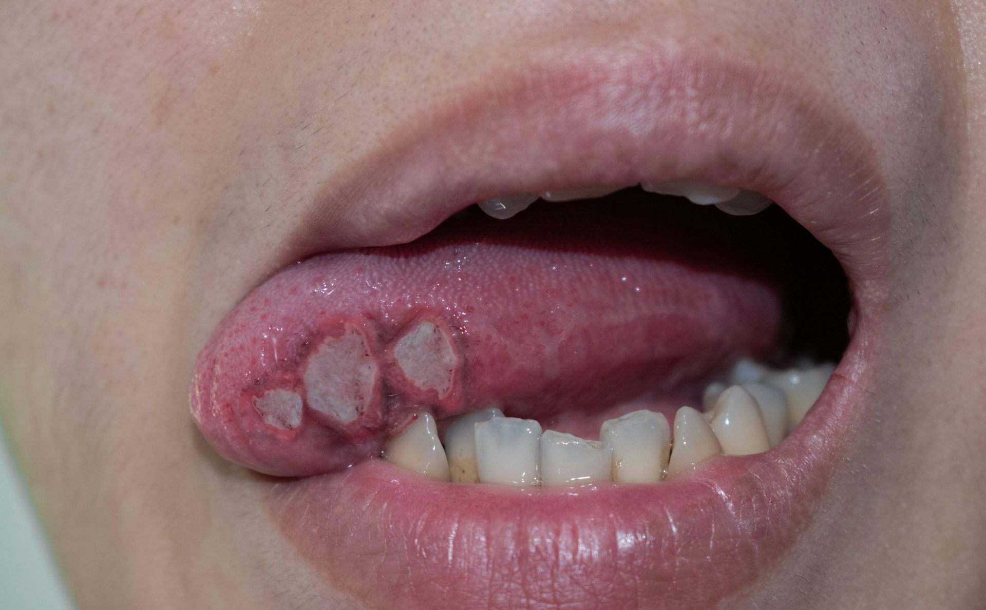 Mouth cancer cases hit new record in England and Scotland – what you ...