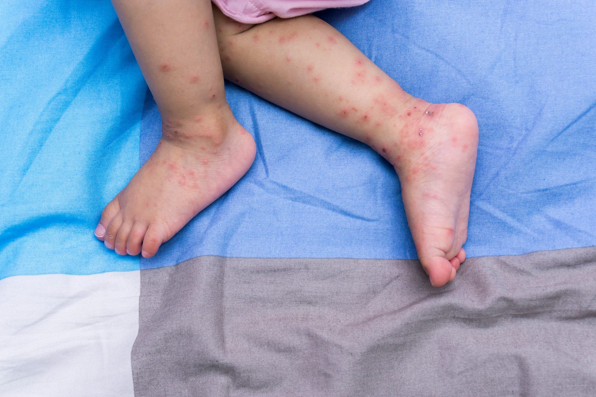 Campak merebak karena masyarakat takut vaksin: 3 cara memahami manfaat ...